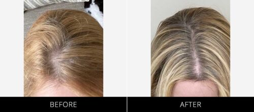 Unlocking the Power of Focal Cryotherapy for Hair Growth - Barber ...