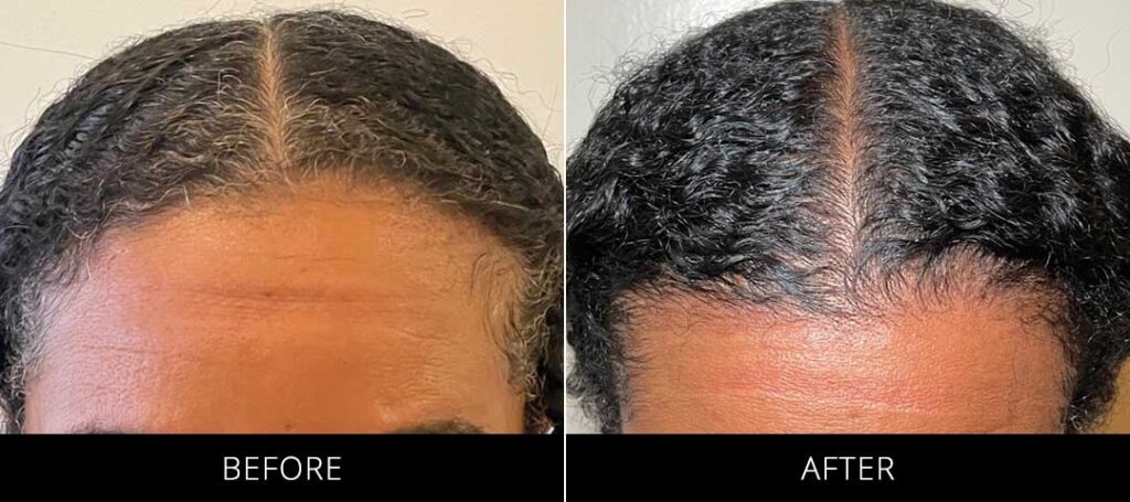 BSG CryoStim Hair Regrowth - Barber Surgeons Guild®