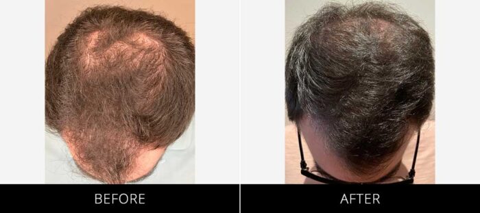 Unlocking the Power of Focal Cryotherapy for Hair Growth - Barber ...